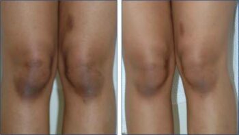 5 ways to lighten knee skin naturally - Green Prophet